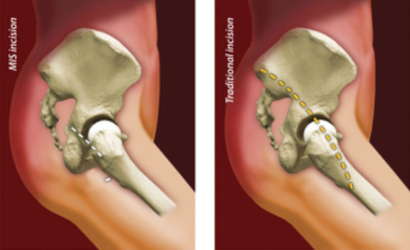 The SPAIRE Posterior Mini Approach – Mako Robotic Surgery Worcestershire